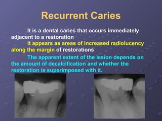 5-Dental Caries radiology in dentistry . | PPTX
