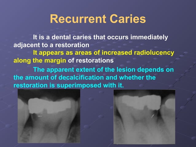 5-Dental Caries radiology in dentistry . | PPT