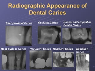 5-Dental Caries radiology in dentistry . | PPTX