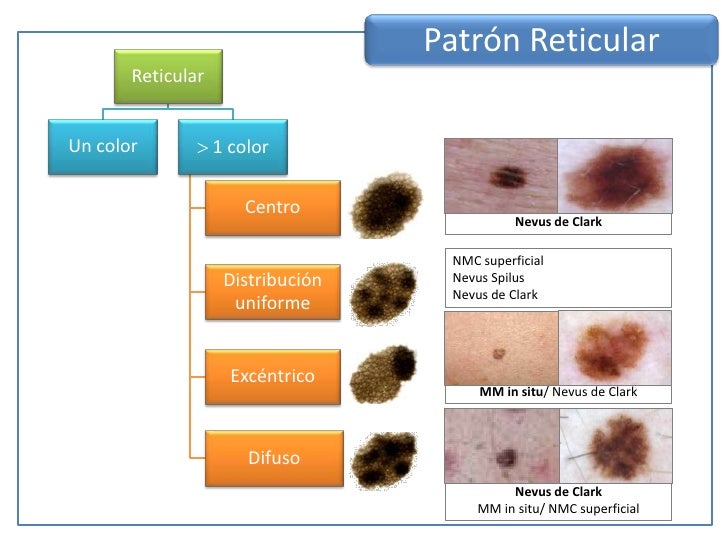 Dermatoscopia en lesiones pigmentarias
