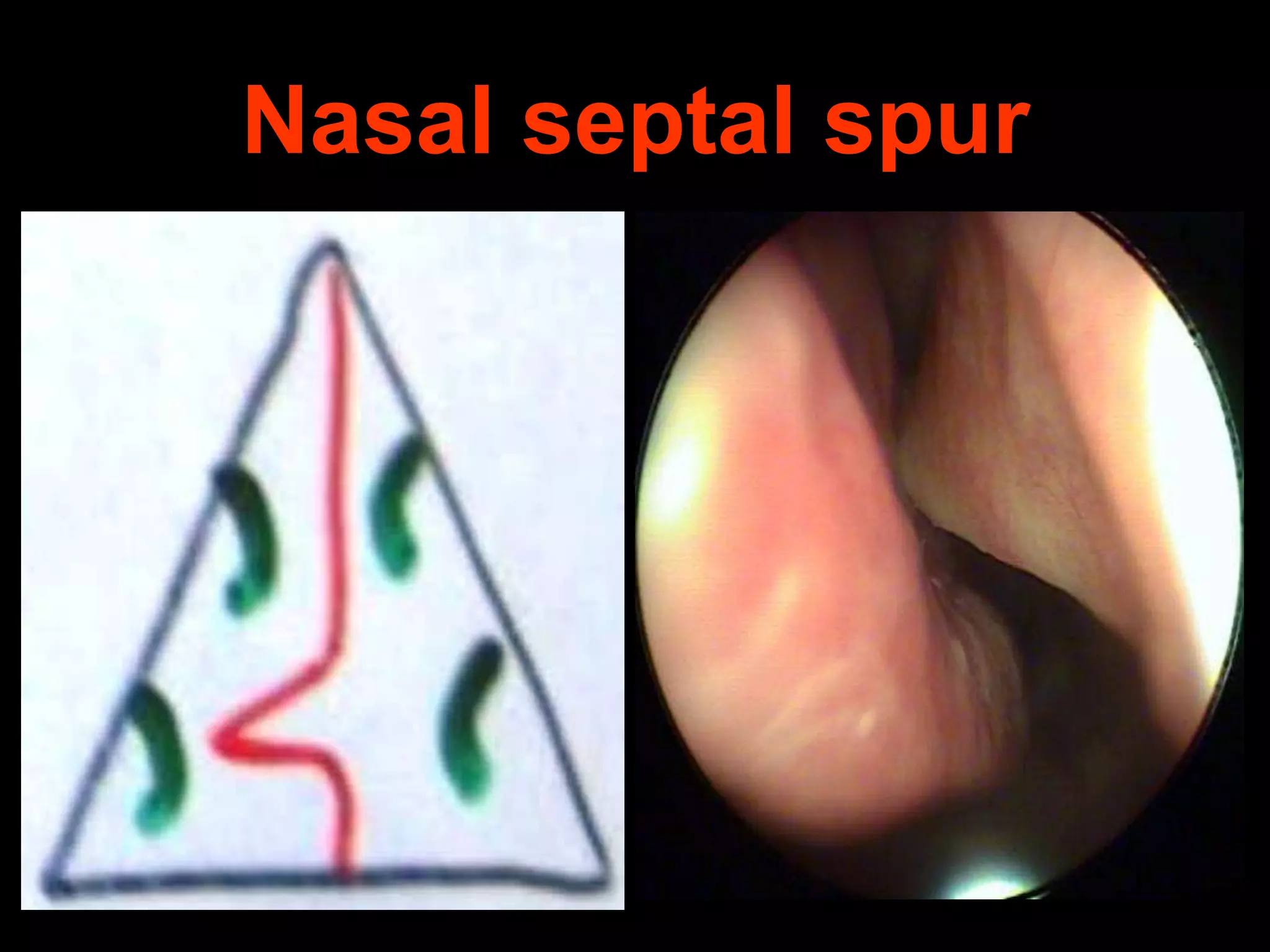 5 deviated-nasal-septum | PPSX