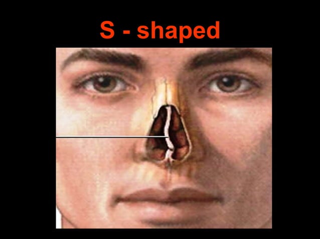 5 deviated-nasal-septum | PPSX | Death, Injury, or Military Conflict ...