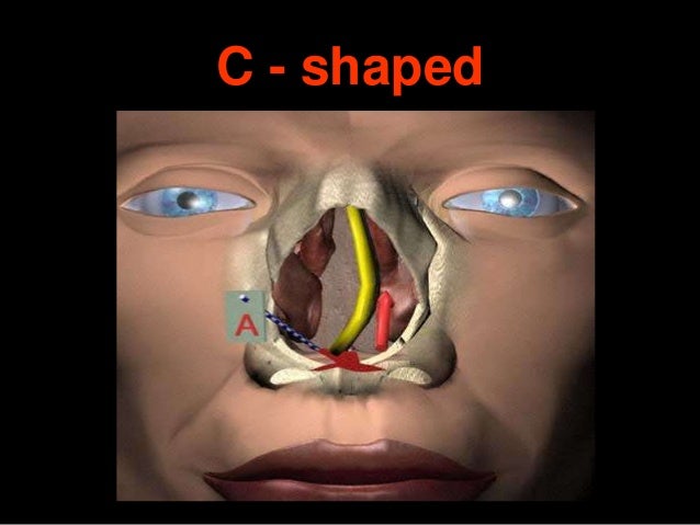 5 deviated-nasal-septum