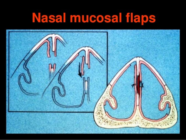5 deviated-nasal-septum