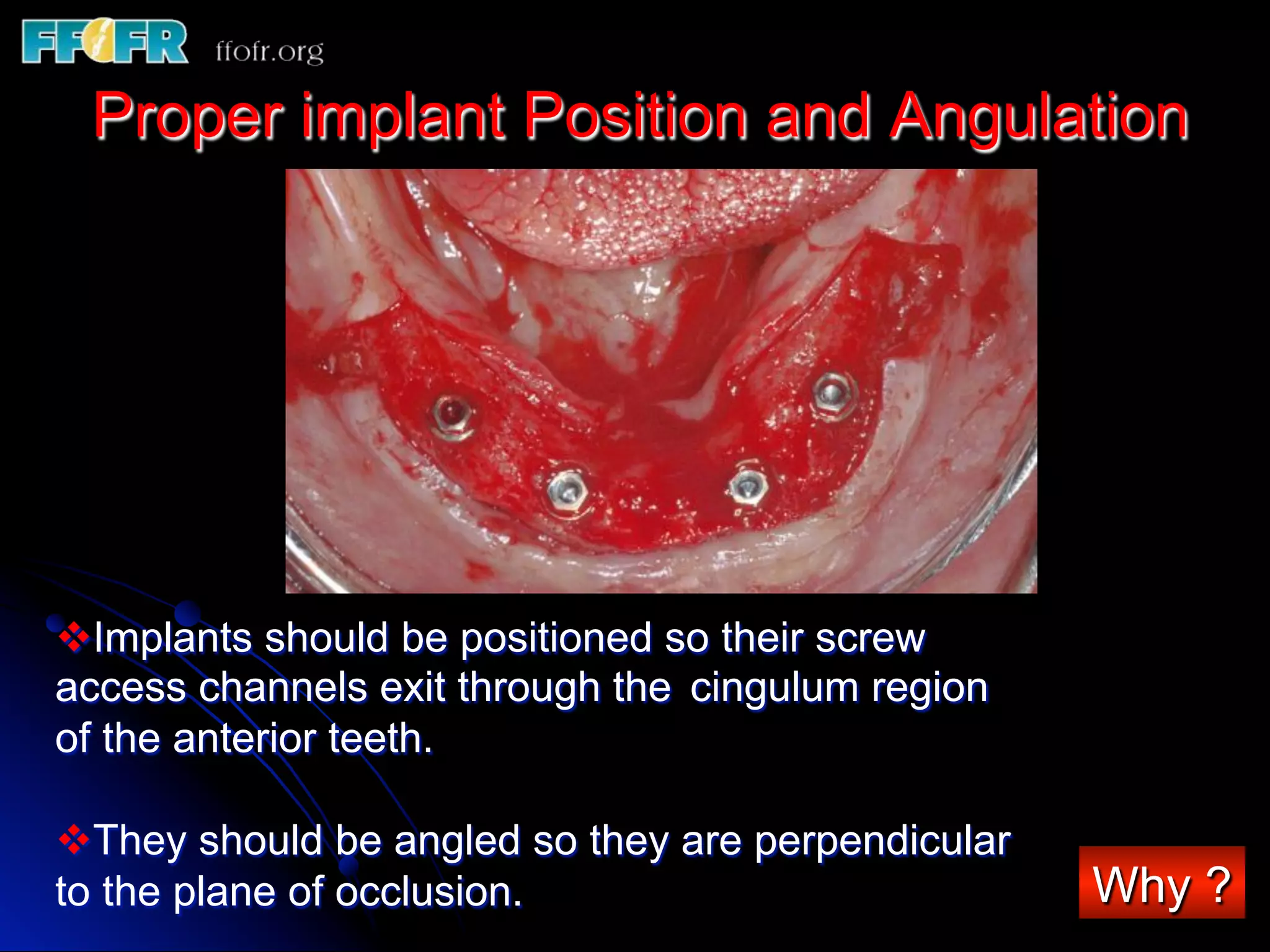 Edentulous Mandible - Fixed Prostheses | PDF