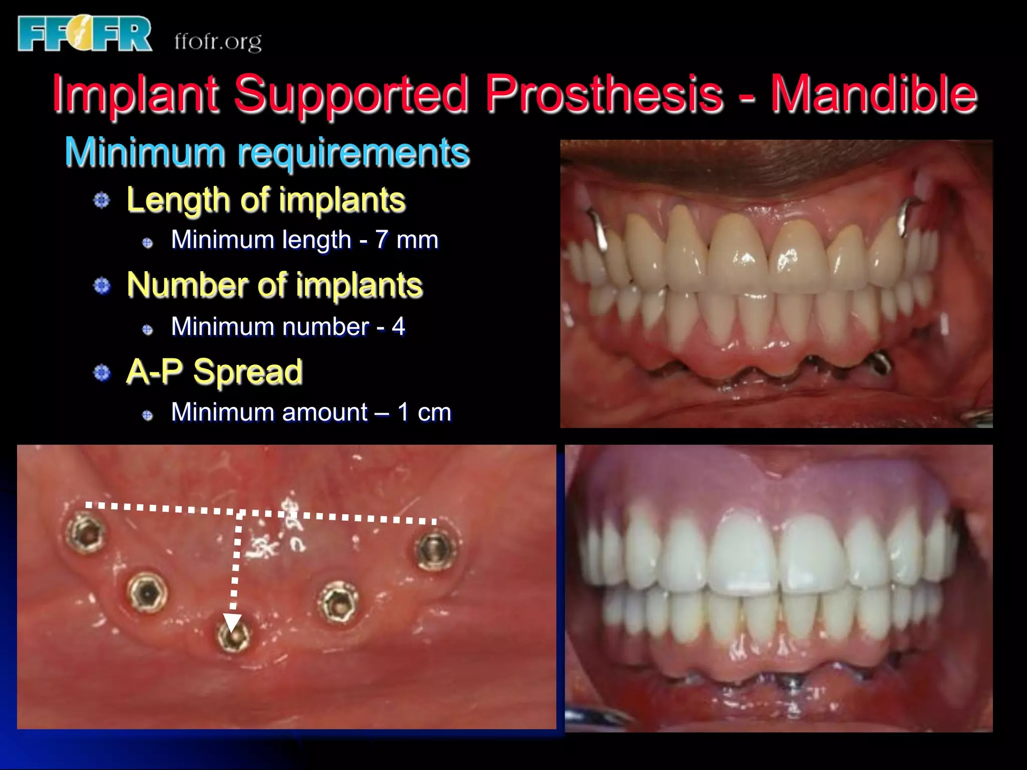 Edentulous Mandible - Fixed Prostheses | PDF