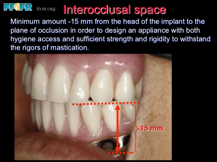 Edentulous Mandible - Fixed Prostheses
