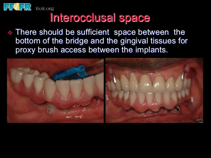 Edentulous Mandible - Fixed Prostheses