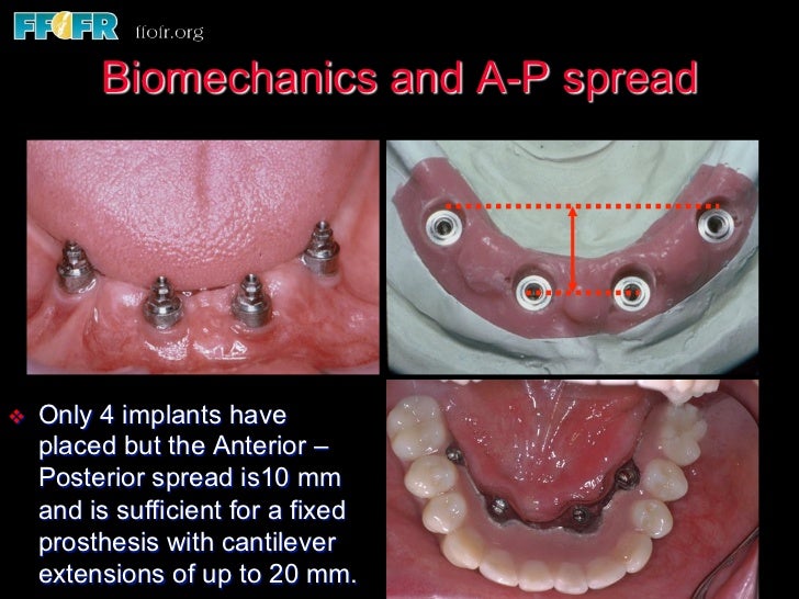 Edentulous Mandible - Fixed Prostheses