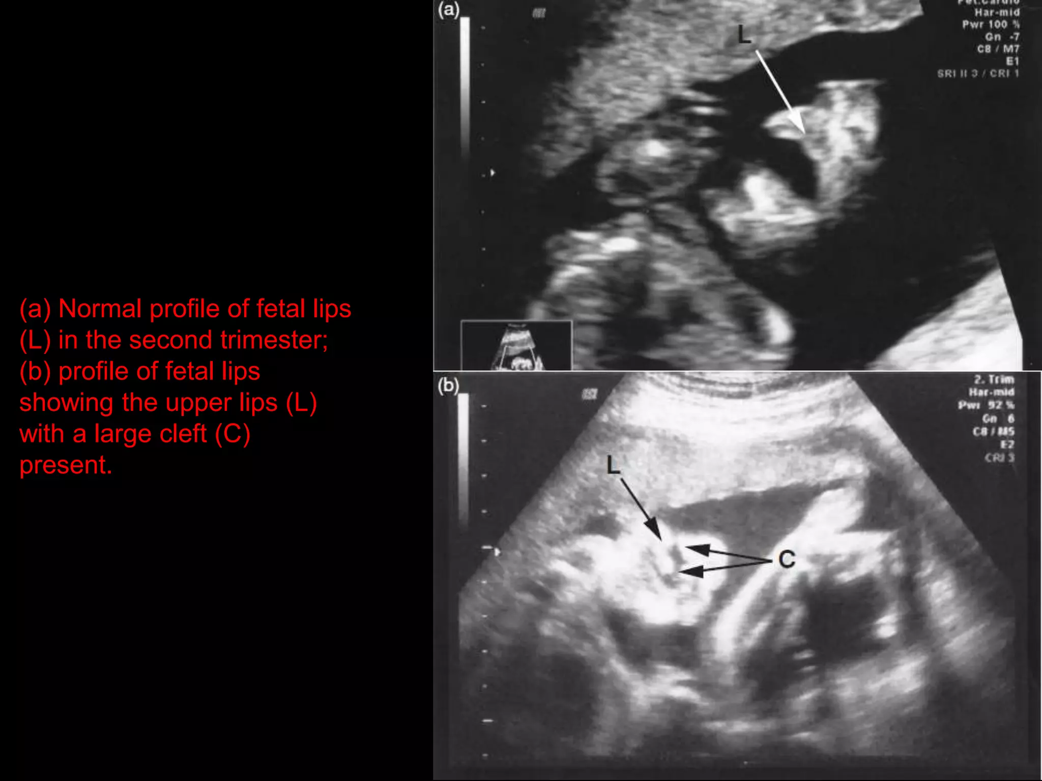 5-Fetal face ultrasound Dr Ahmed Esawy | PDF