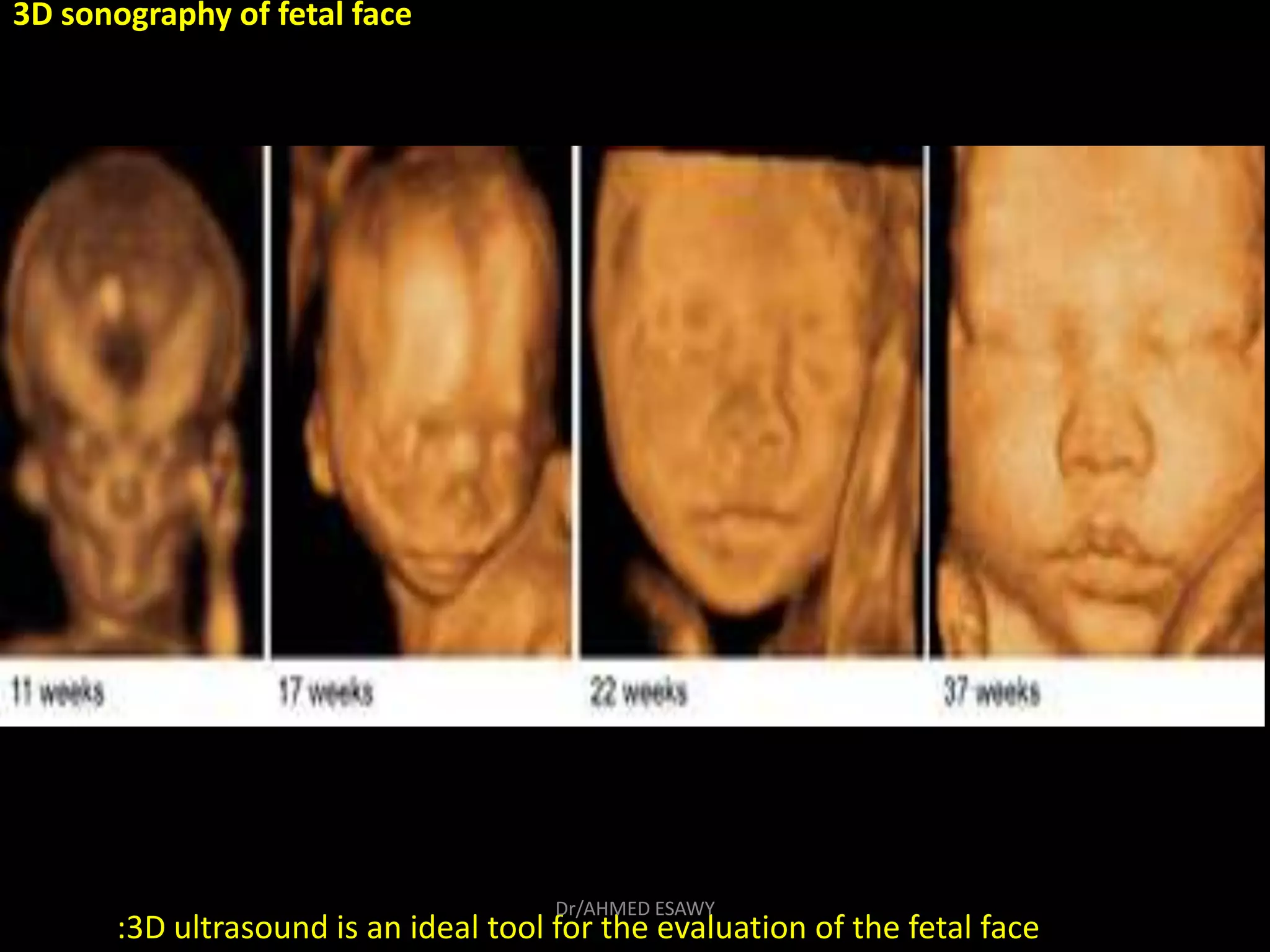 5-Fetal face ultrasound Dr Ahmed Esawy | PDF