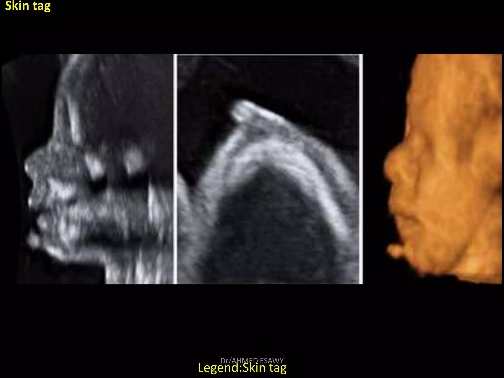 5-Fetal face ultrasound Dr Ahmed Esawy | PDF