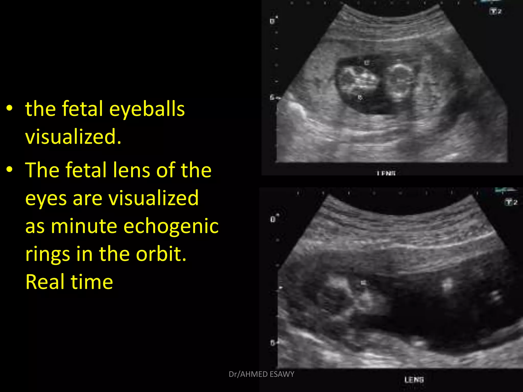 5-Fetal face ultrasound Dr Ahmed Esawy | PDF