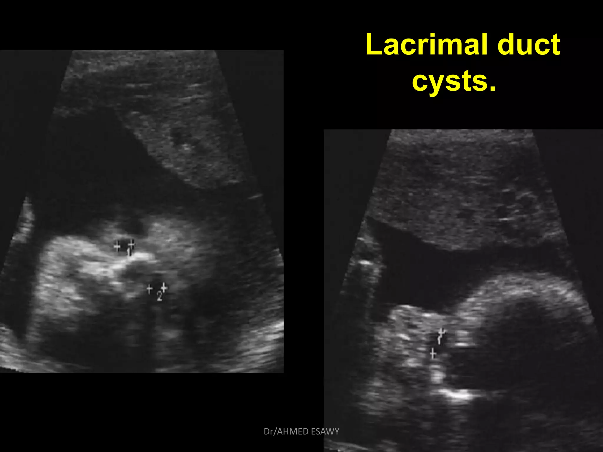 5 Fetal Face Ultrasound Dr Ahmed Esawy Ppt