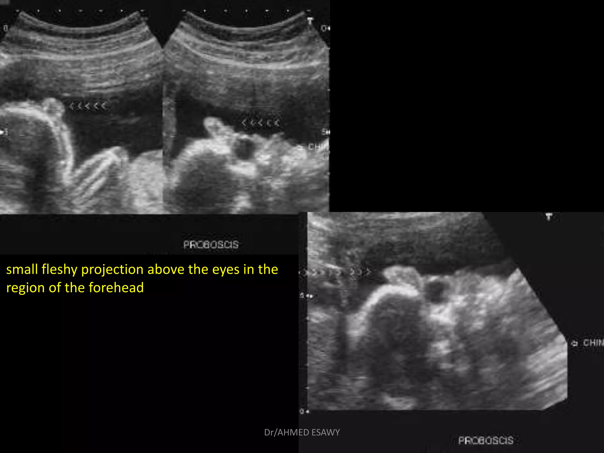 5 Fetal Face Ultrasound Dr Ahmed Esawy Ppt