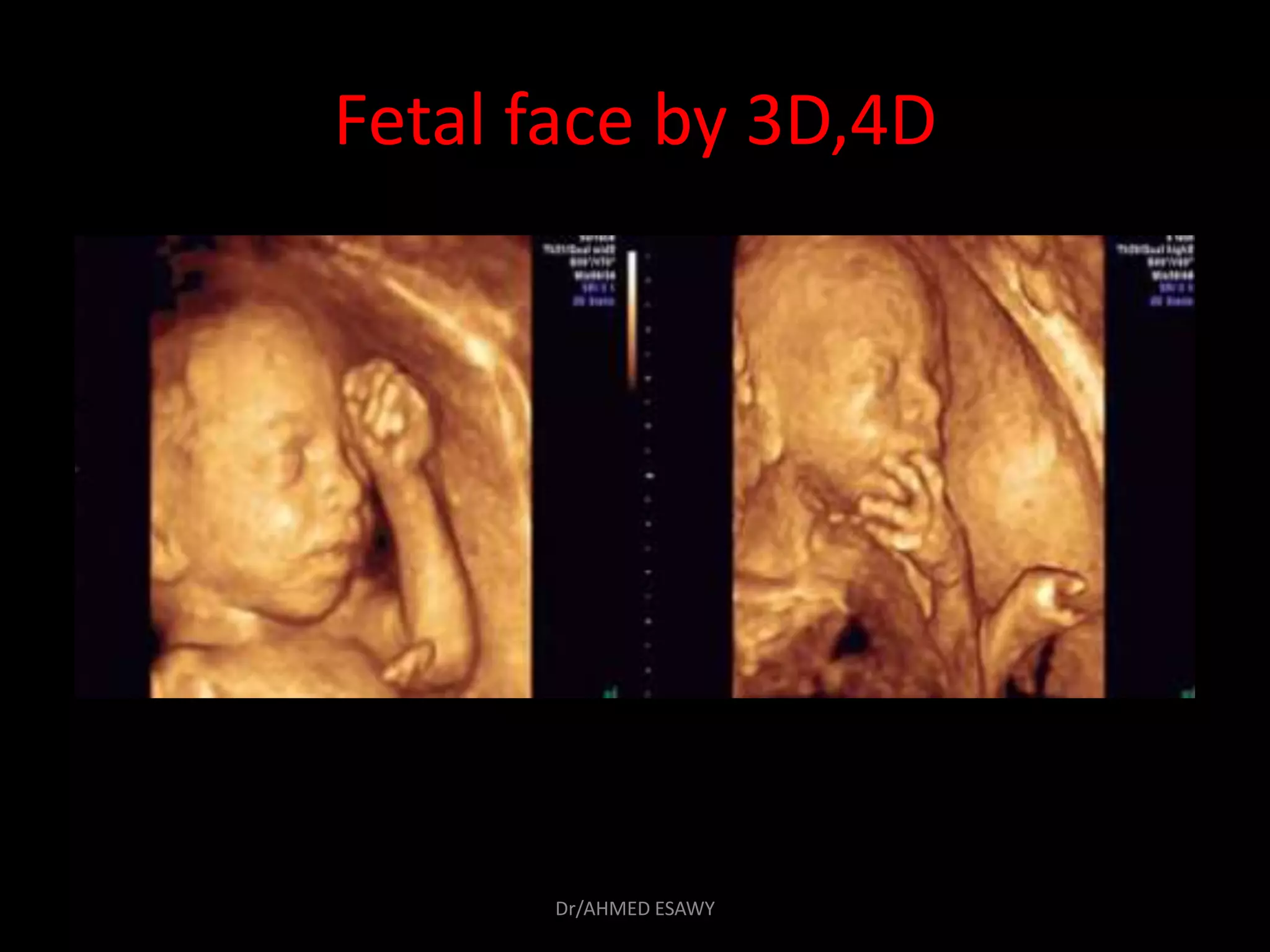 5-Fetal face ultrasound Dr Ahmed Esawy | PDF
