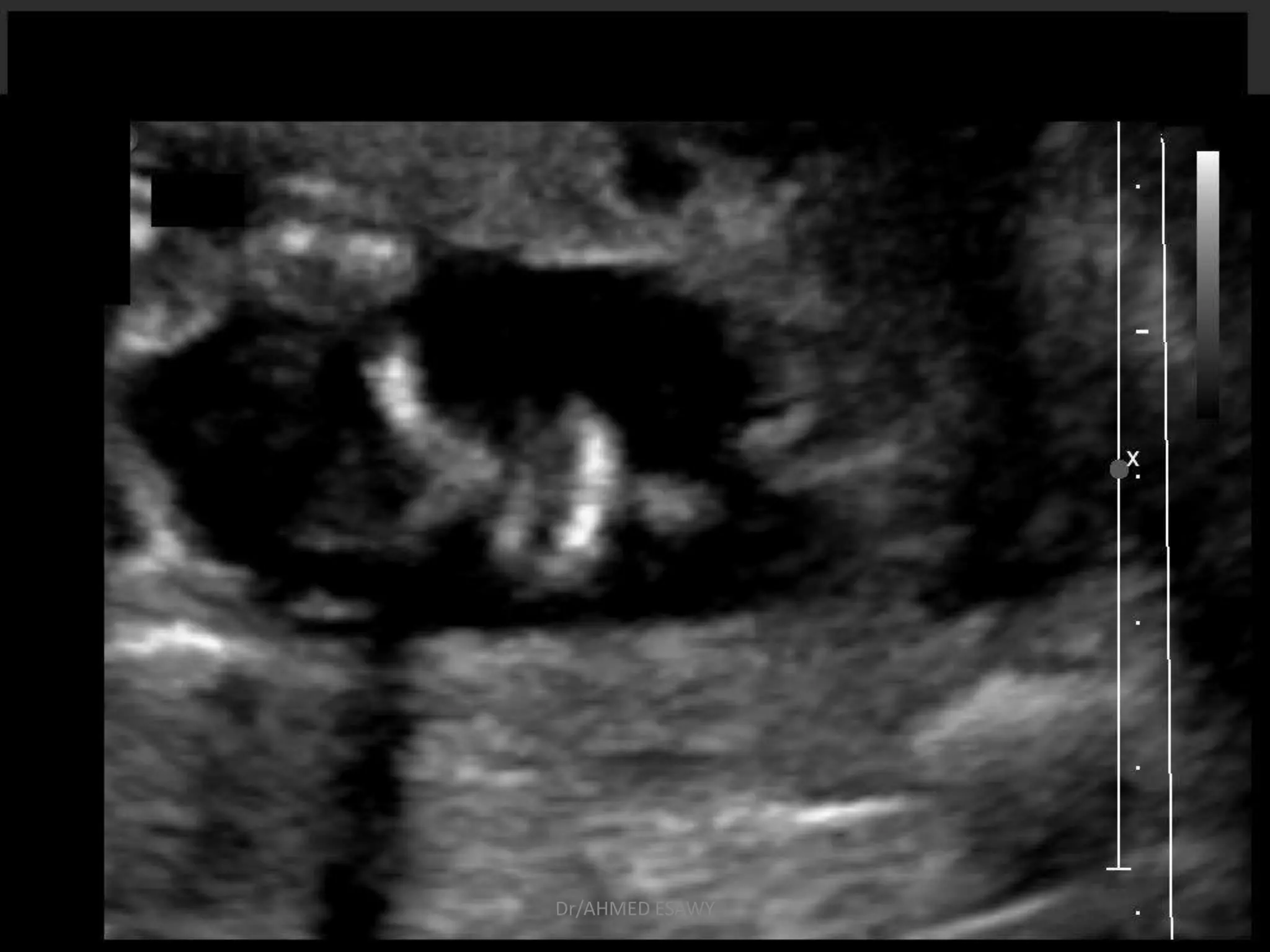 5-Fetal face ultrasound Dr Ahmed Esawy | PDF