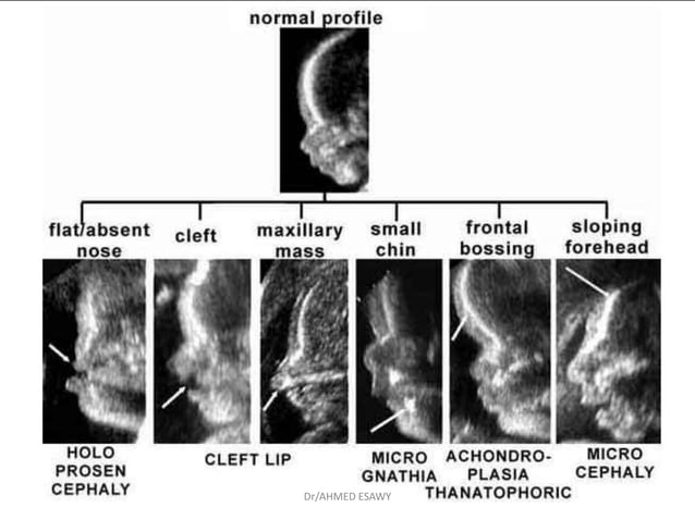 5-Fetal face ultrasound Dr Ahmed Esawy | PDF