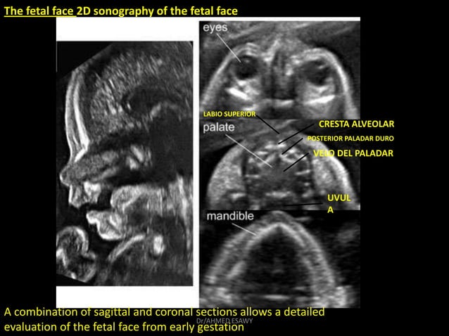 5-Fetal face ultrasound Dr Ahmed Esawy | PDF