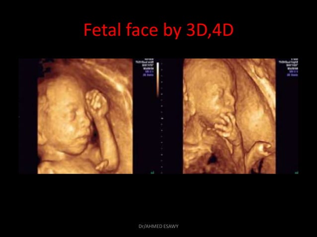 5-Fetal face ultrasound Dr Ahmed Esawy | PDF