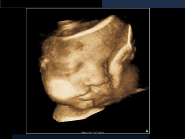 5-Fetal face ultrasound Dr Ahmed Esawy | PDF