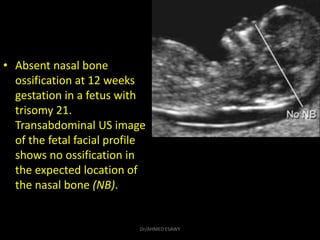 5-Fetal face ultrasound Dr Ahmed Esawy | PDF