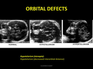Hypotelorism Ultrasound
