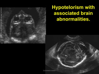 Hypotelorism Ultrasound