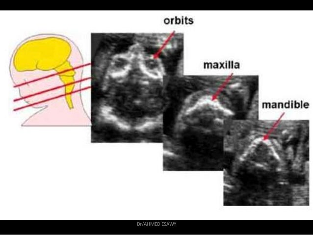 5-Fetal face ultrasound Dr Ahmed Esawy