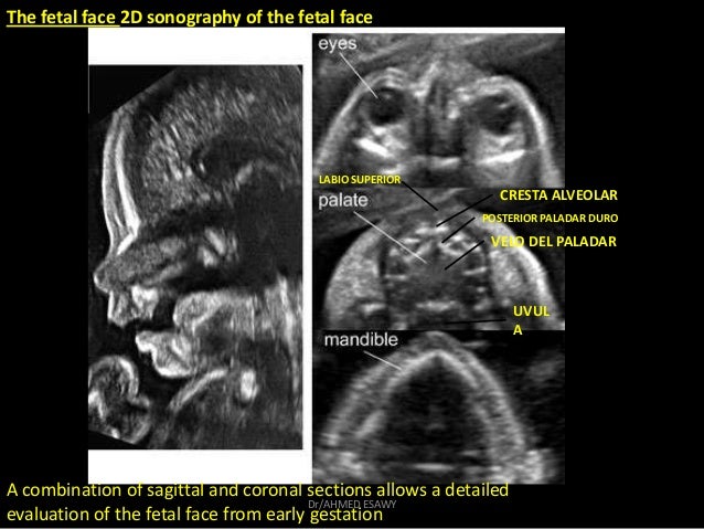 5-Fetal face ultrasound Dr Ahmed Esawy