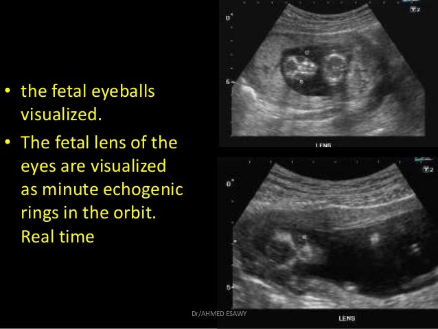 5-Fetal face ultrasound Dr Ahmed Esawy
