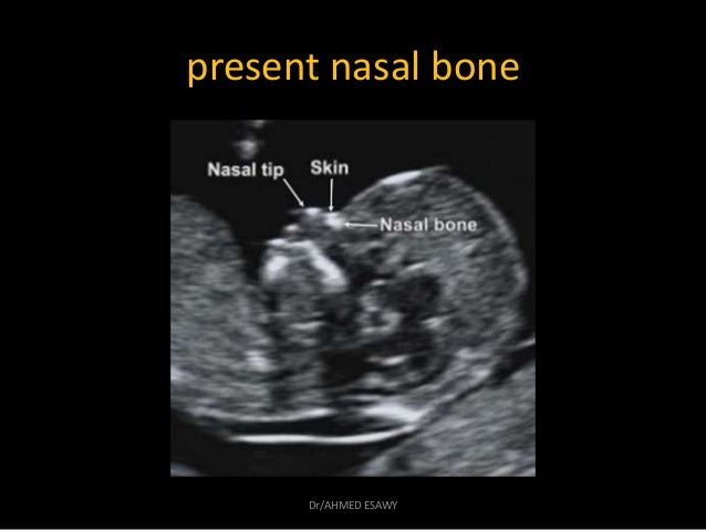 5-Fetal face ultrasound Dr Ahmed Esawy