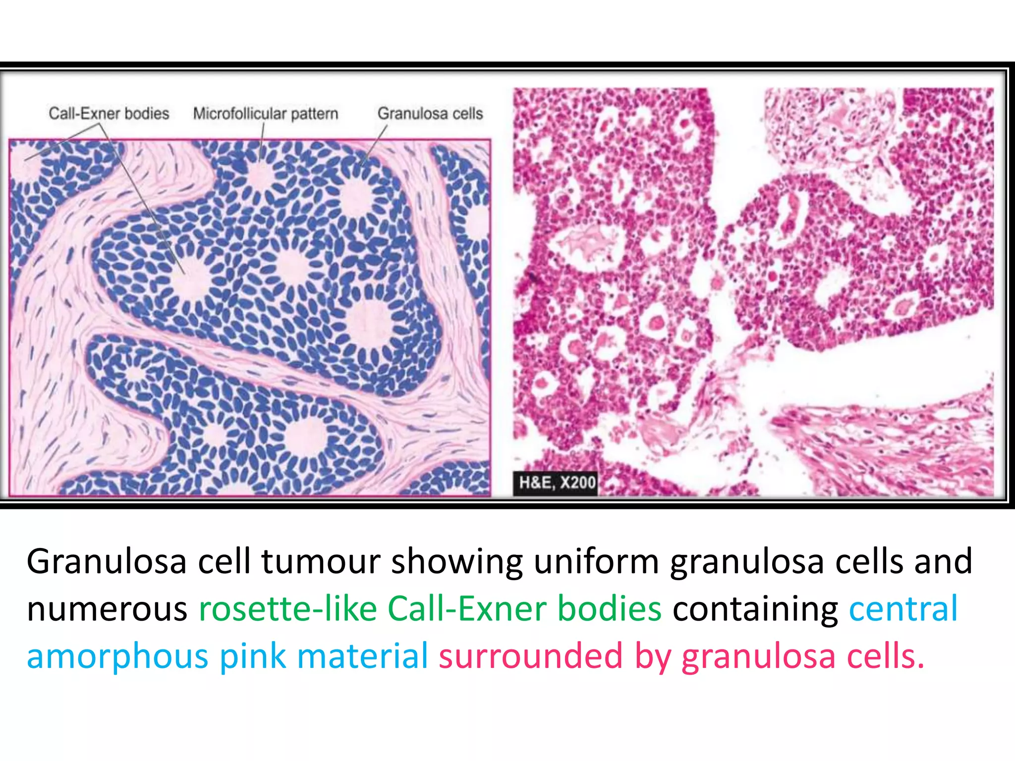 OVARIAN TUMOURS | PPTX