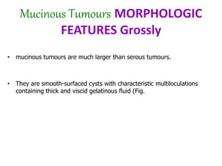 OVARIAN TUMOURS | PPTX