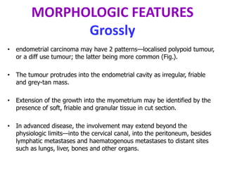ENDOMETRIAL CARCINOMA | PPTX
