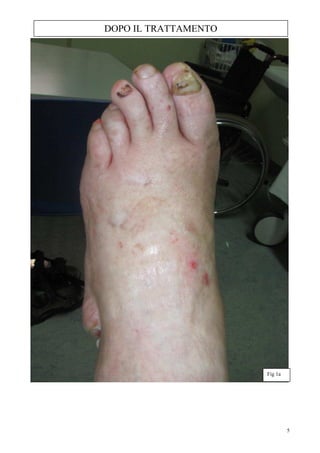 Gestione Multidisciplinare Integrata In Un Caso Complesso Di Piede ...