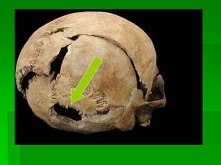 5 - Head injuries for nurses in emergency room | PPT | First Aid | Injuries