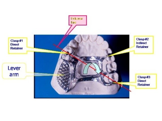 5 indirect retainers