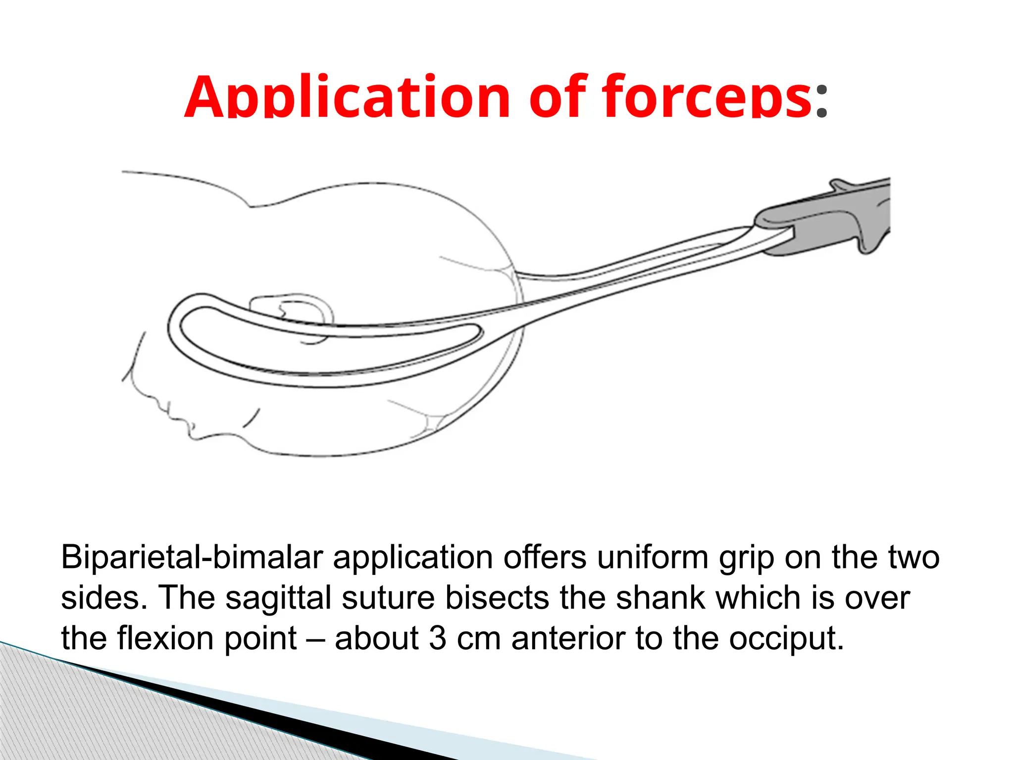 5- instrumental delivery OBS GYN.6666666666666666pptx | PPTX