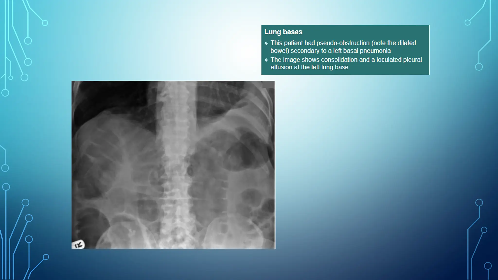ABDOMINAL XRAYS- LUNG BASES, SOFT TISSUES AND BONES. | PDF