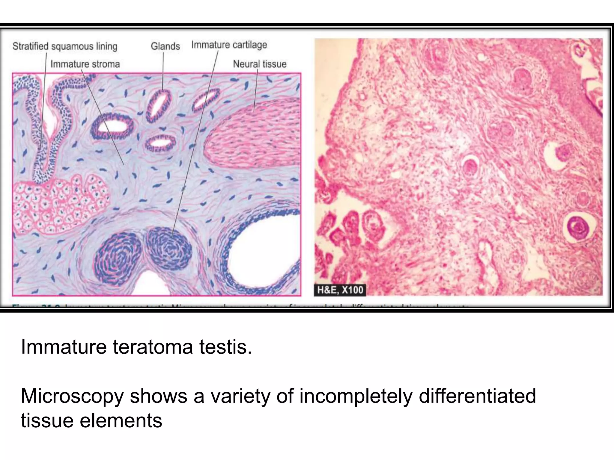 MALE GENITAL SYSTEM - TESTICULAR TUMOURS | PPTX