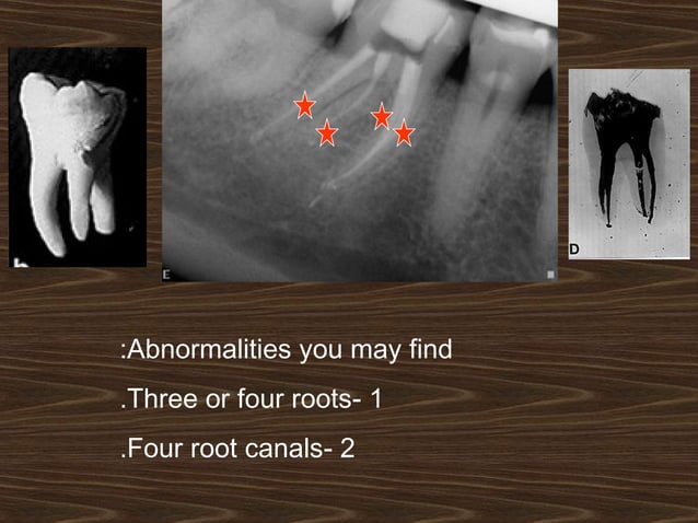 5 mandibular molars | PPT | Dental Health | Diseases and Conditions