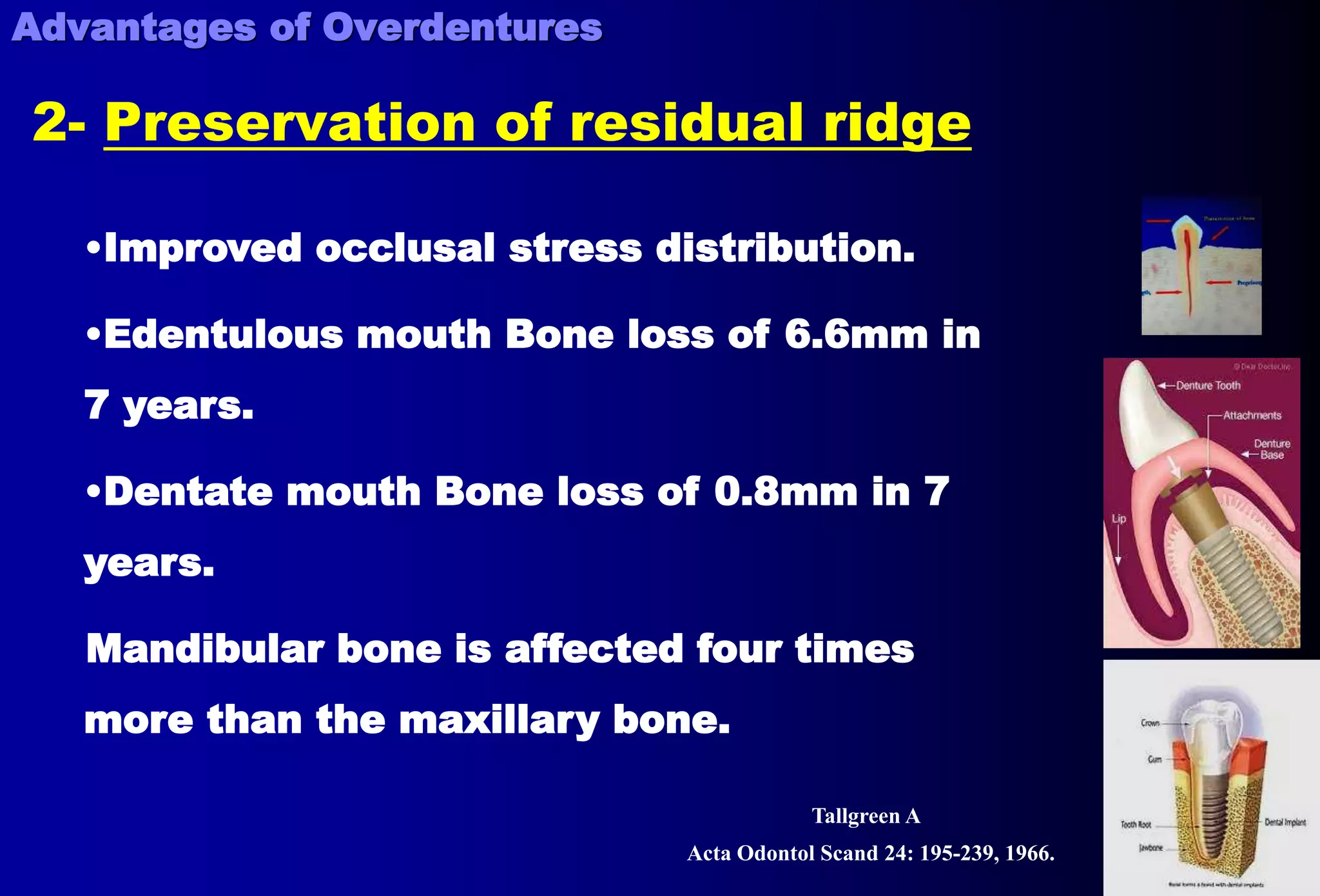 5- OVERDENTURE.pptx