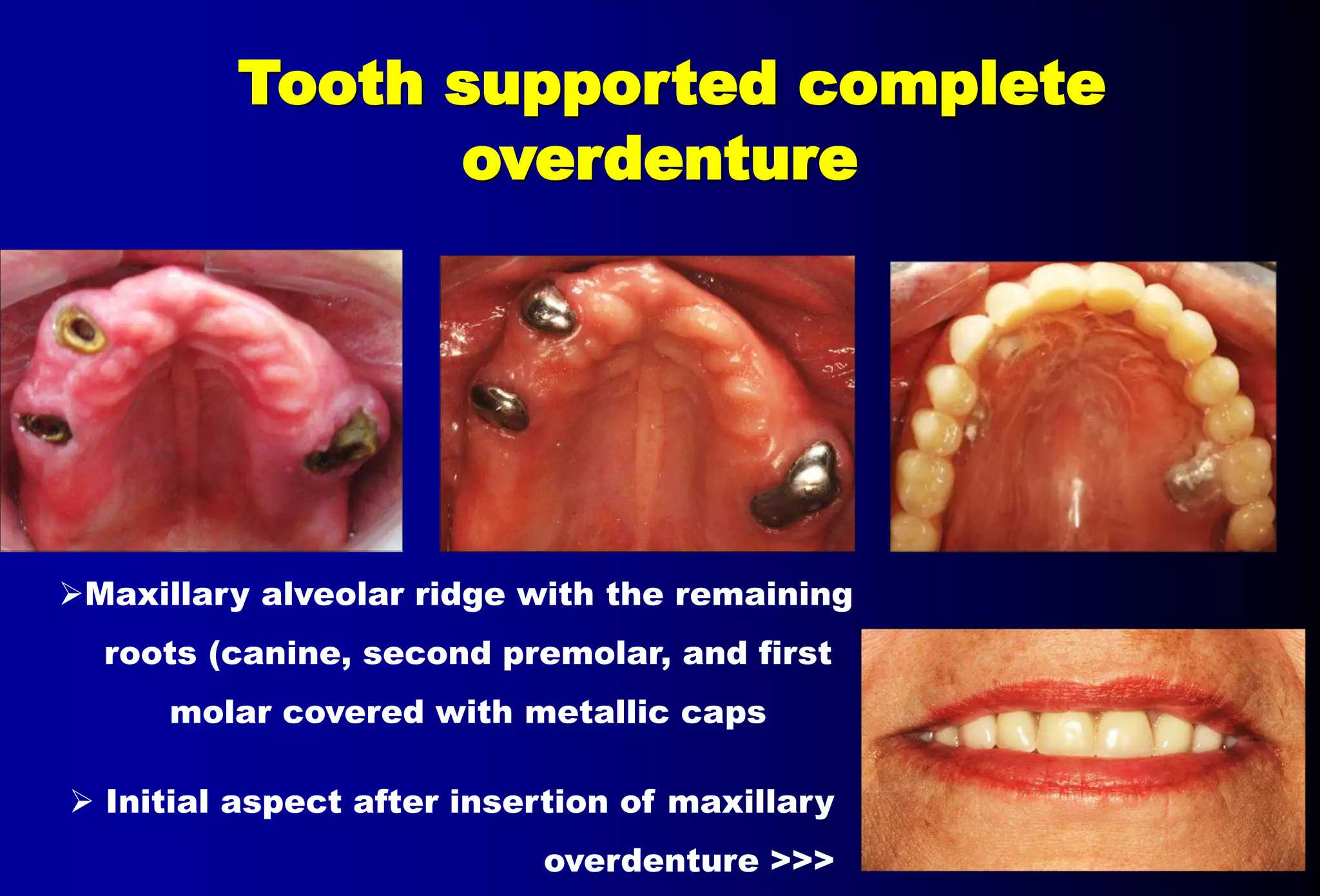 5- OVERDENTURE.pptx