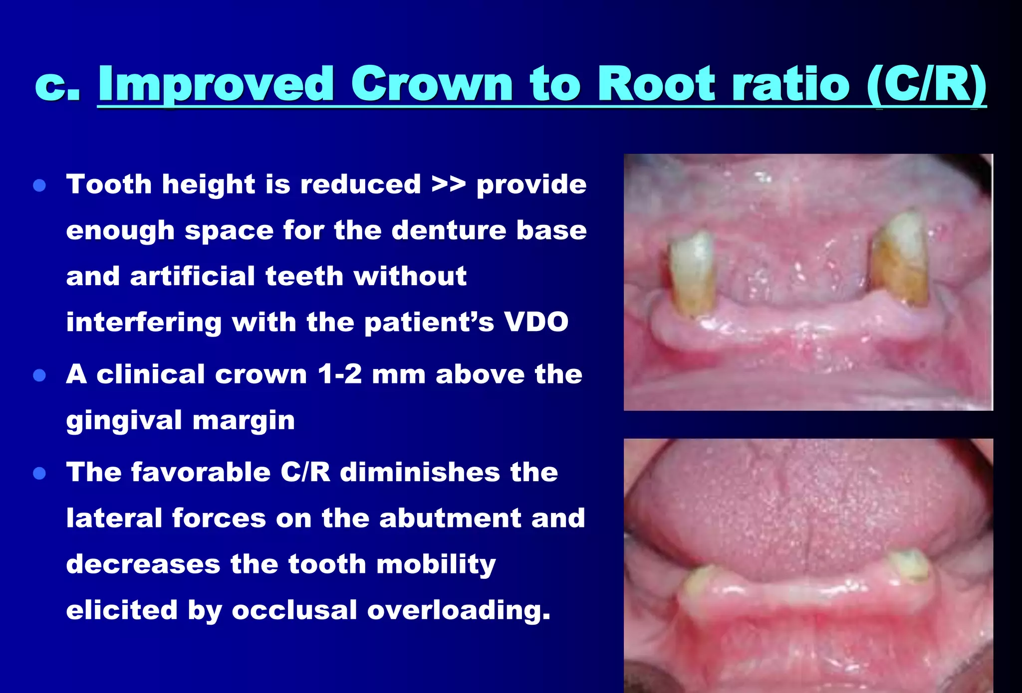 5- OVERDENTURE.pptx