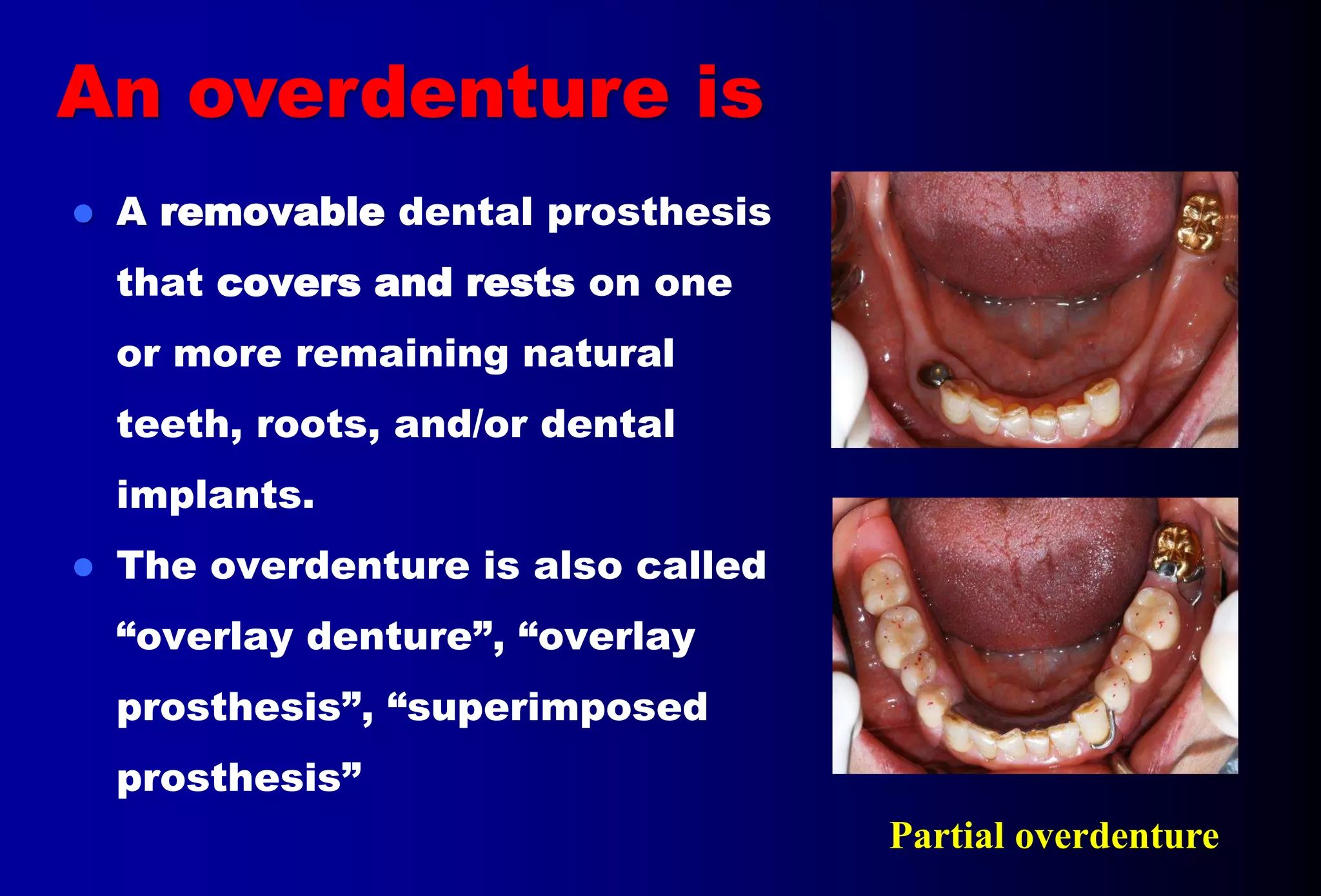 5- OVERDENTURE.pptx