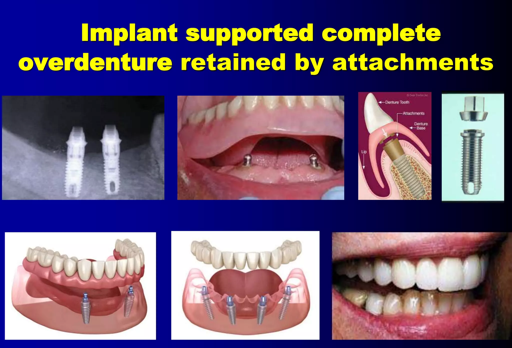 5- OVERDENTURE.pptx