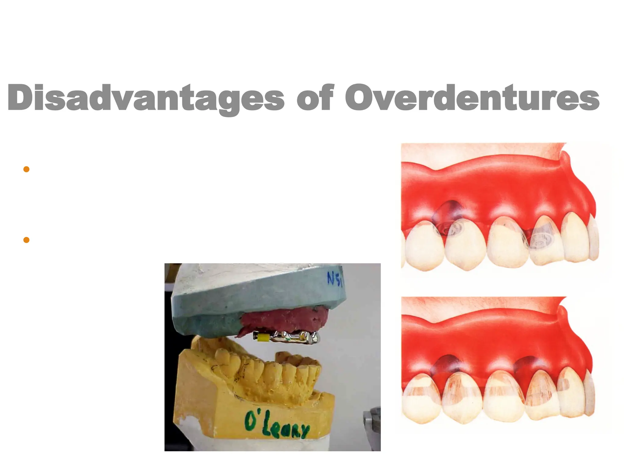 5-over denture new removable prosthodontics .ppt