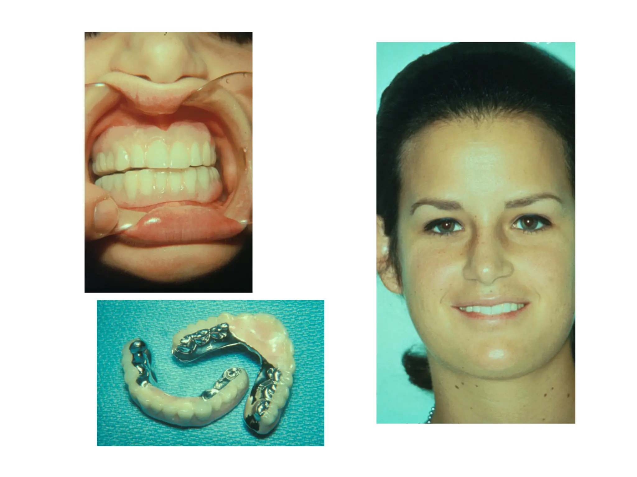 5-over denture new removable prosthodontics .ppt