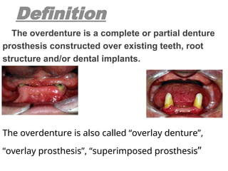 5-over denture new removable prosthodontics .ppt